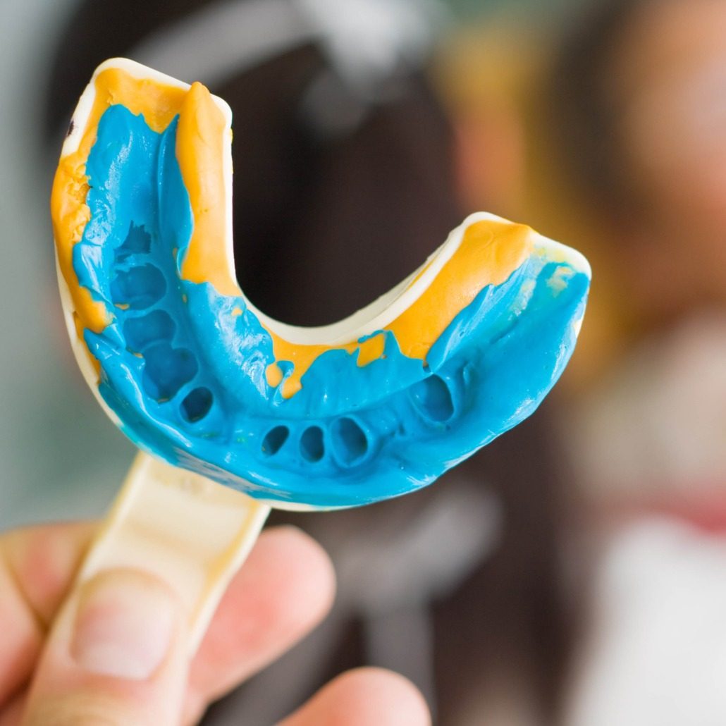 What is it like to have at-home clear aligner treatment